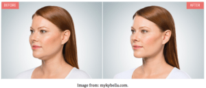 Kybella Neck Fat reduction Dallas | Plano | Austin Texas