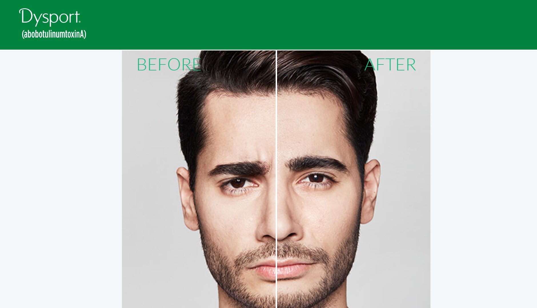 Dysport Dermal Filler Before After Photos Dallas, Plano, Austin, Texas